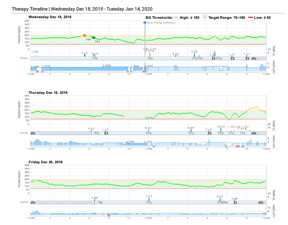 ControlIQ Review – T1D in the CLE